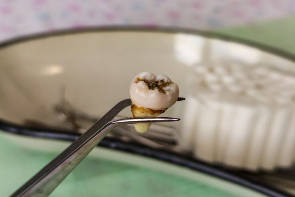 Understanding Tooth Extraction Recovery: Healing Timeline Explained