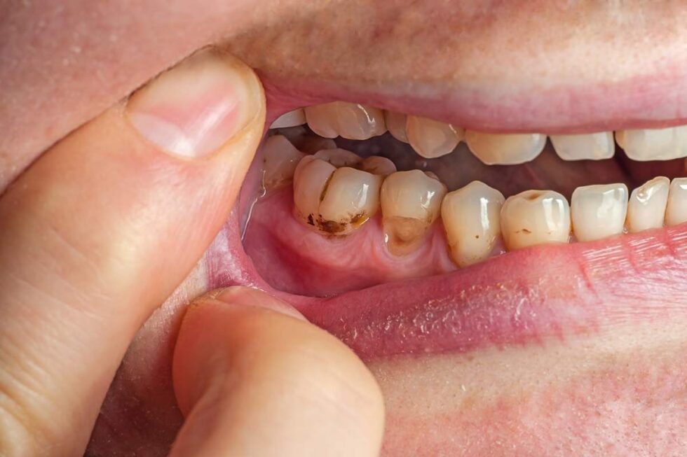 Sugar and Cavities: How Dr. Brent Stanley Can Help