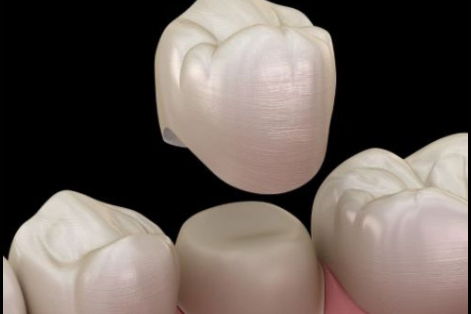 Are Same-Day Crowns Durable for Gilbert Patients?